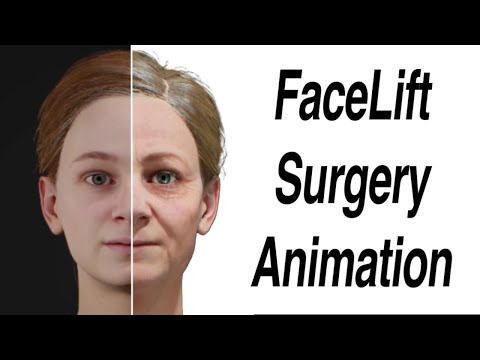FaceLift Surgery Animation | Flokii